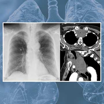 Guidelines & Topic Collections - American College of Chest Physicians