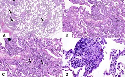 Interstitial Lung Disease | About CHEST Guidelines - American College ...