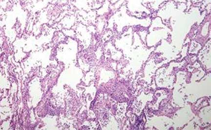 Interventional Pulmonary | About CHEST Guidelines - American College of ...